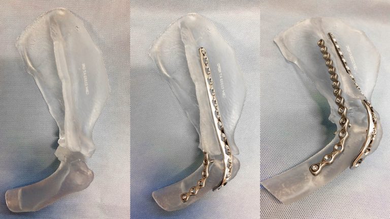 Shoulder Arthrodesis - Wales Centre for Advanced Batch Manufacturing